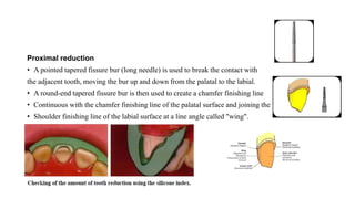 Porcelain Fused to Metal Crown in prosthodontics.pptx