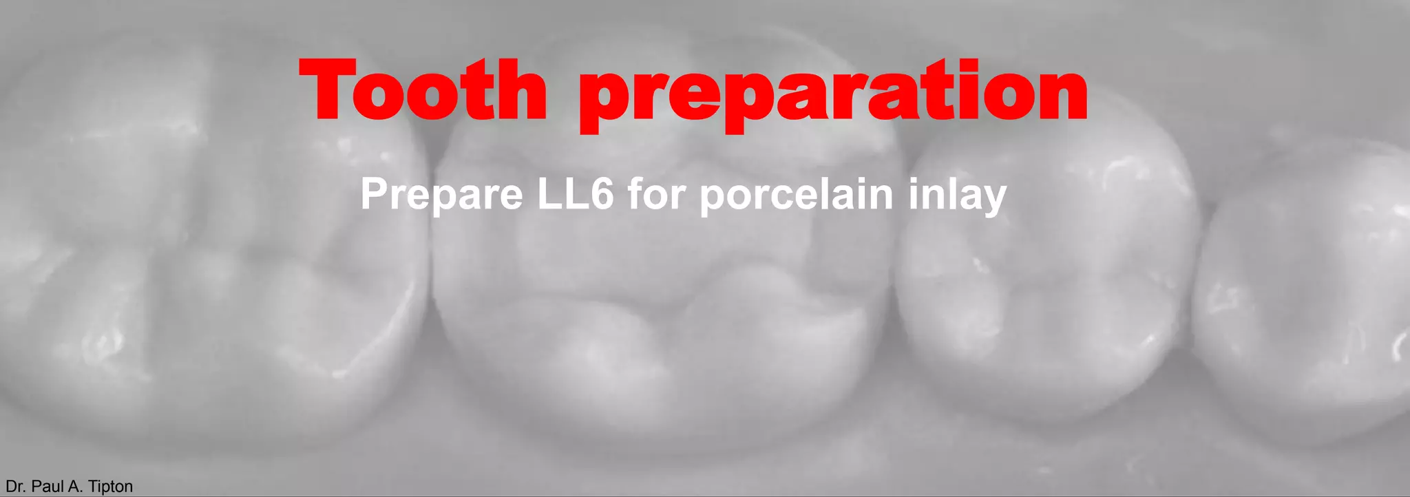 Tooth Preparation - Porcelain Inlays & Onlays | PDF