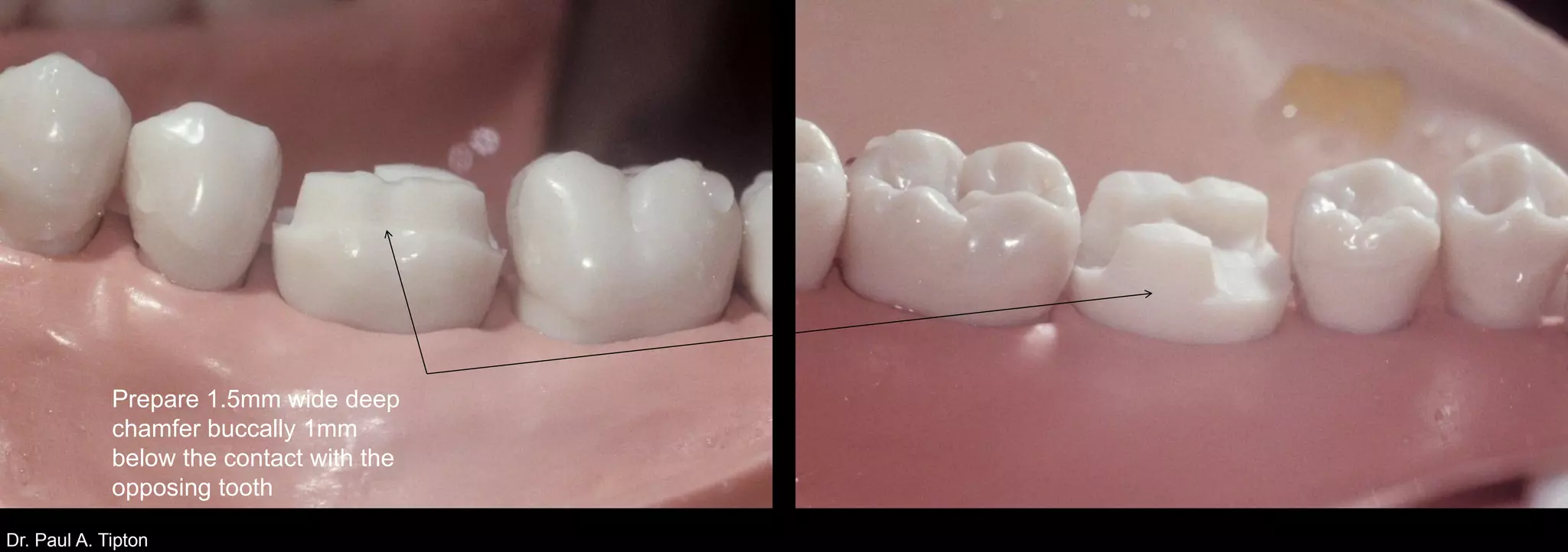 Tooth Preparation - Porcelain Inlays & Onlays | PDF | Dental Health ...