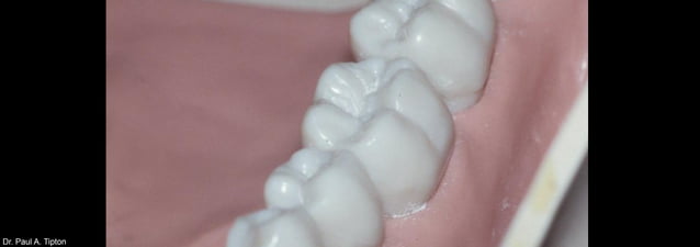 Tooth Preparation - Porcelain Inlays & Onlays | PDF | Dental Health ...
