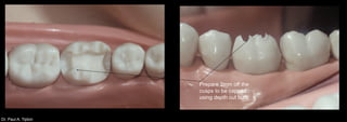 Tooth Preparation - Porcelain Inlays & Onlays | PDF