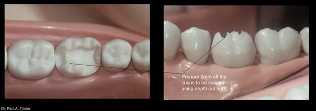 Tooth Preparation - Porcelain Inlays & Onlays | PDF | Dental Health ...
