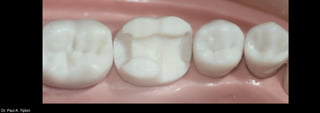 Tooth Preparation - Porcelain Inlays & Onlays | PDF