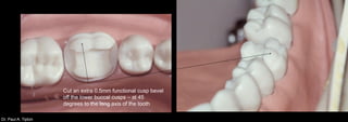 Tooth Preparation - Porcelain Inlays & Onlays | PDF
