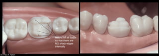 Tooth Preparation - Porcelain Inlays & Onlays | PPT