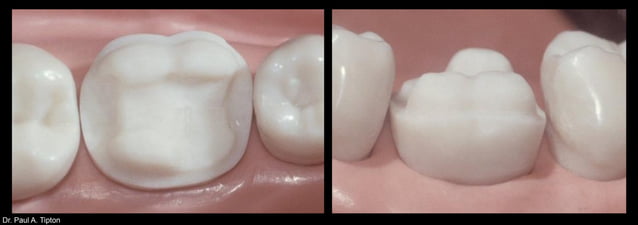 Tooth Preparation - Porcelain Inlays & Onlays | PDF | Dental Health ...