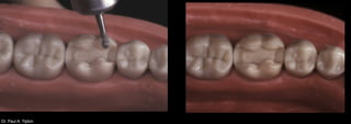 Tooth Preparation - Porcelain Inlays & Onlays | PDF