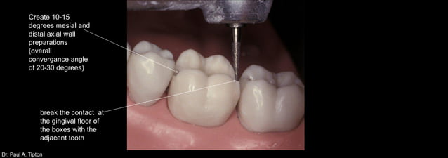 Tooth Preparation - Porcelain Inlays & Onlays | PDF | Dental Health ...