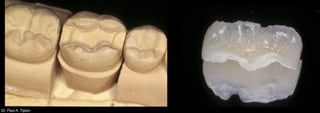 Tooth Preparation - Porcelain Inlays & Onlays | PDF
