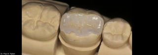 Tooth Preparation - Porcelain Inlays & Onlays | PDF