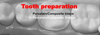 Tooth Preparation - Porcelain Inlays & Onlays | PPT
