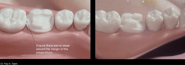 Tooth Preparation - Porcelain Inlays & Onlays