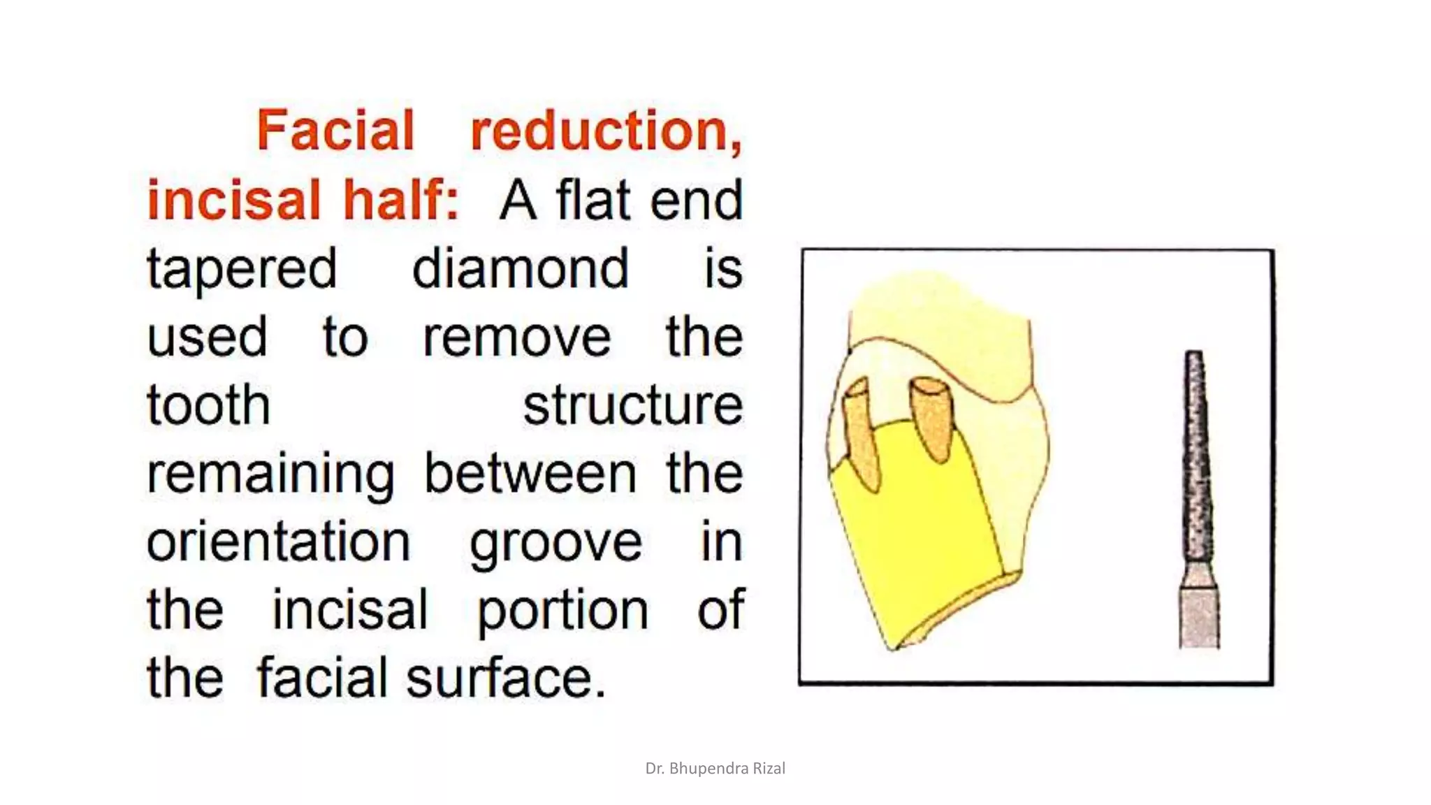 Porcelain jacket crown (PJC) | PPTX