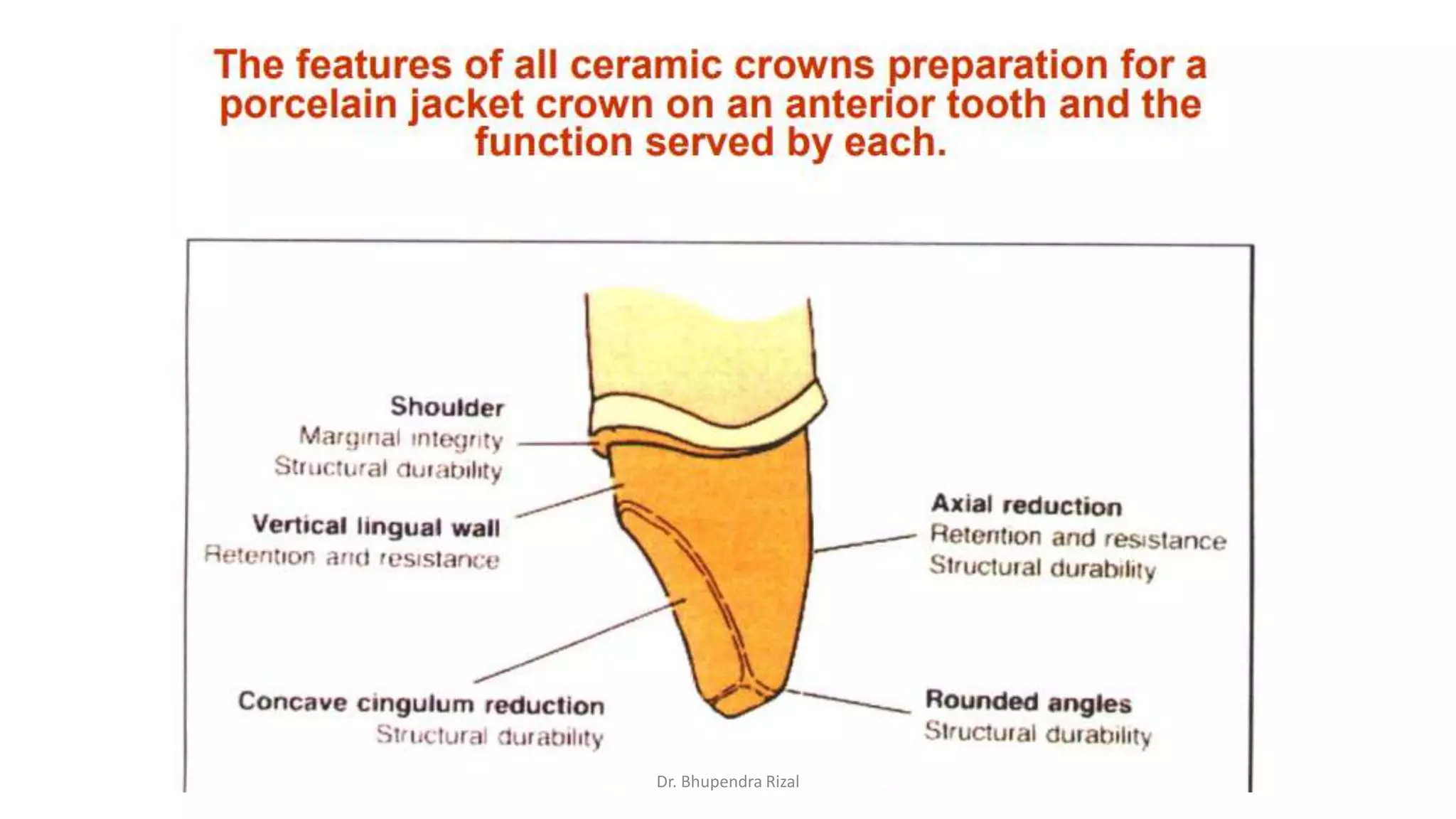 Porcelain jacket crown (PJC) | PPTX