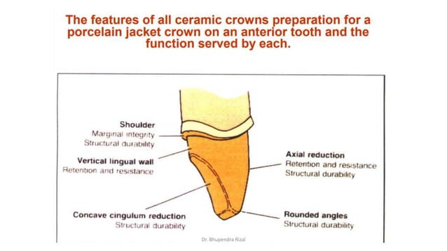 Porcelain jacket crown (PJC) | PPTX