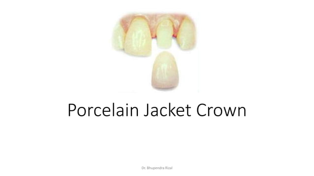 Porcelain jacket crown (PJC)