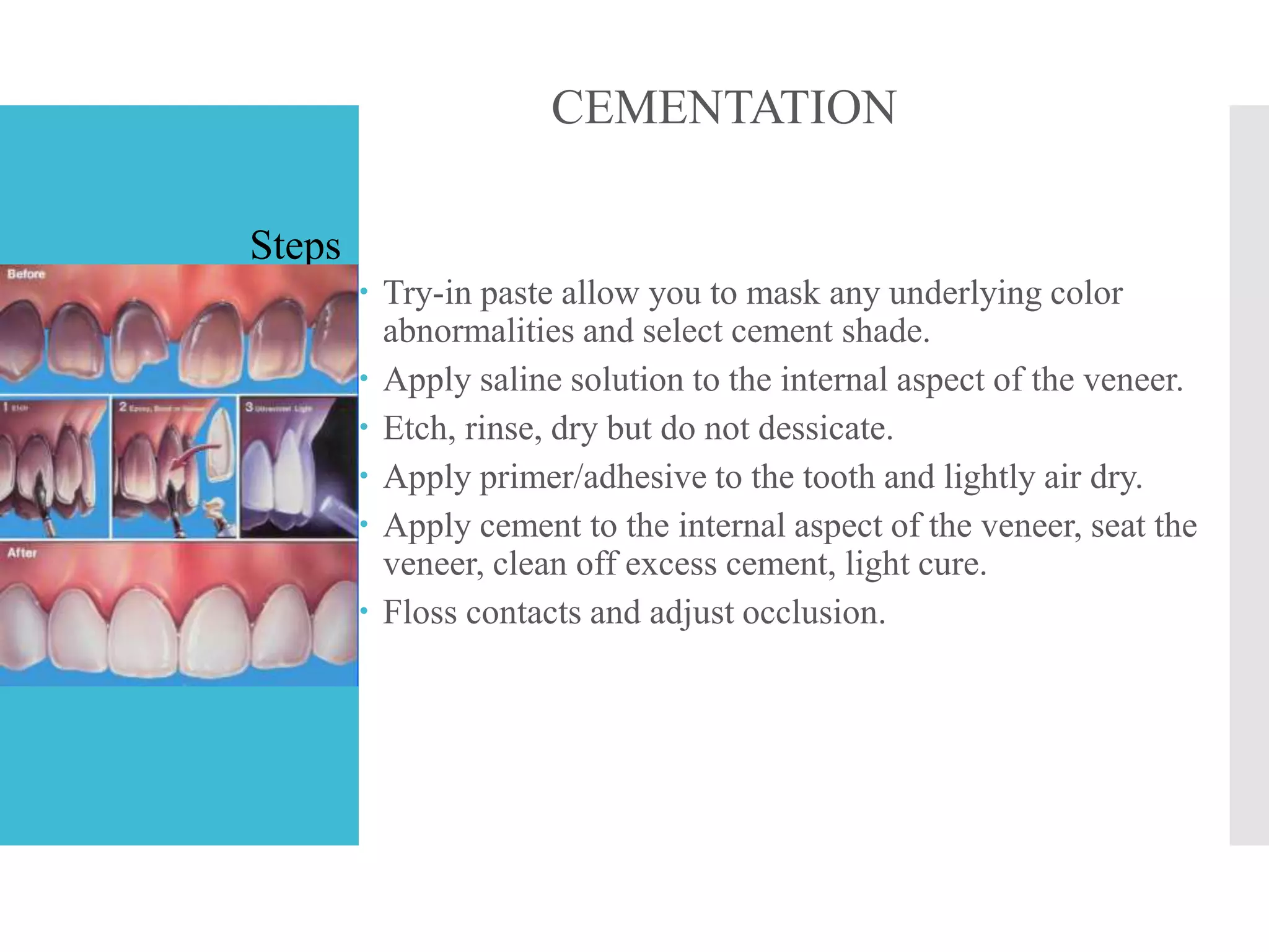 Porcelain laminate veneers (Dentistry) | PPTX