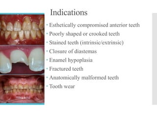 Porcelain laminate veneers (Dentistry) | PPTX
