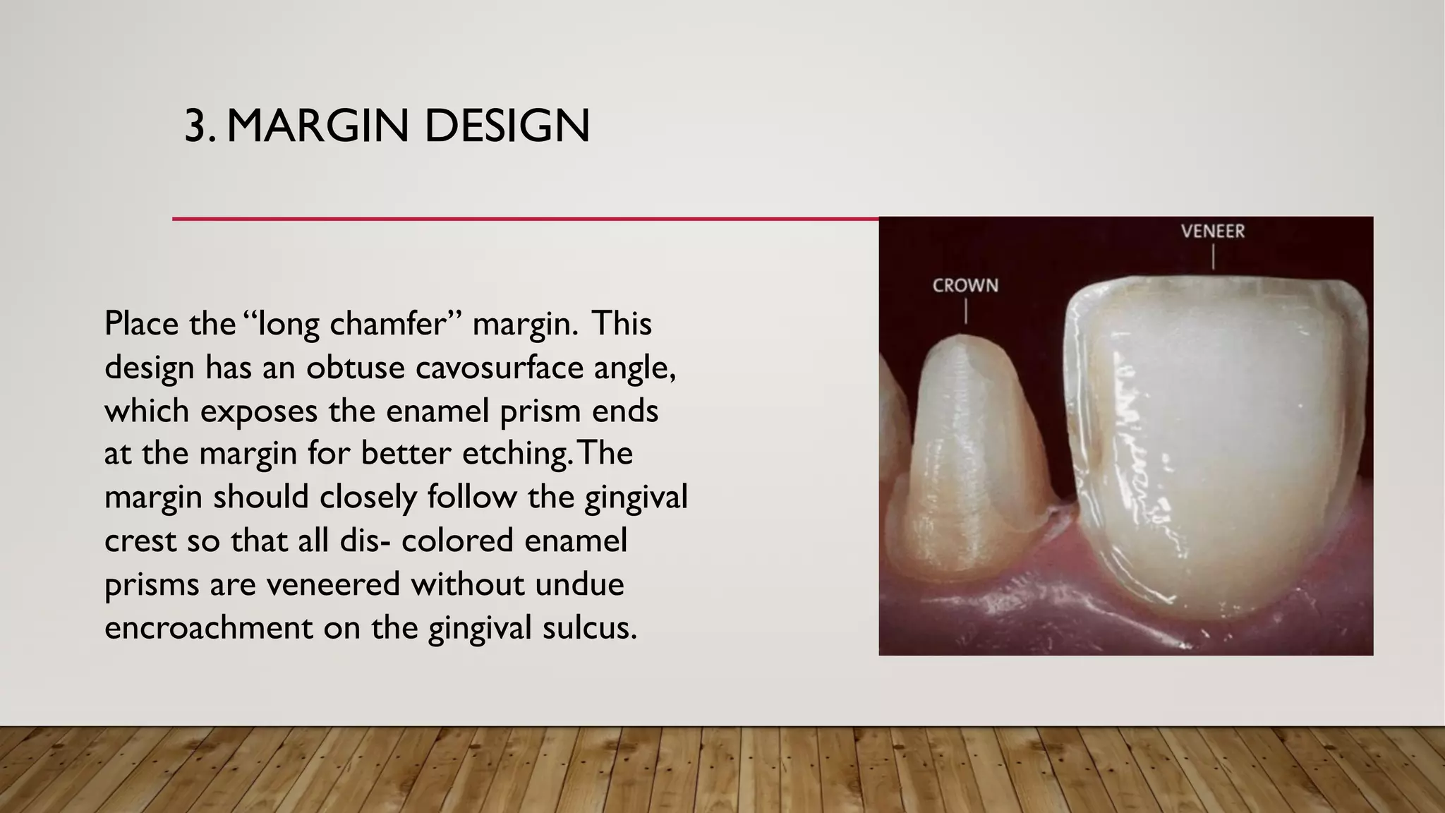 PORCELAIN LAMINATE VENEERS.pdf