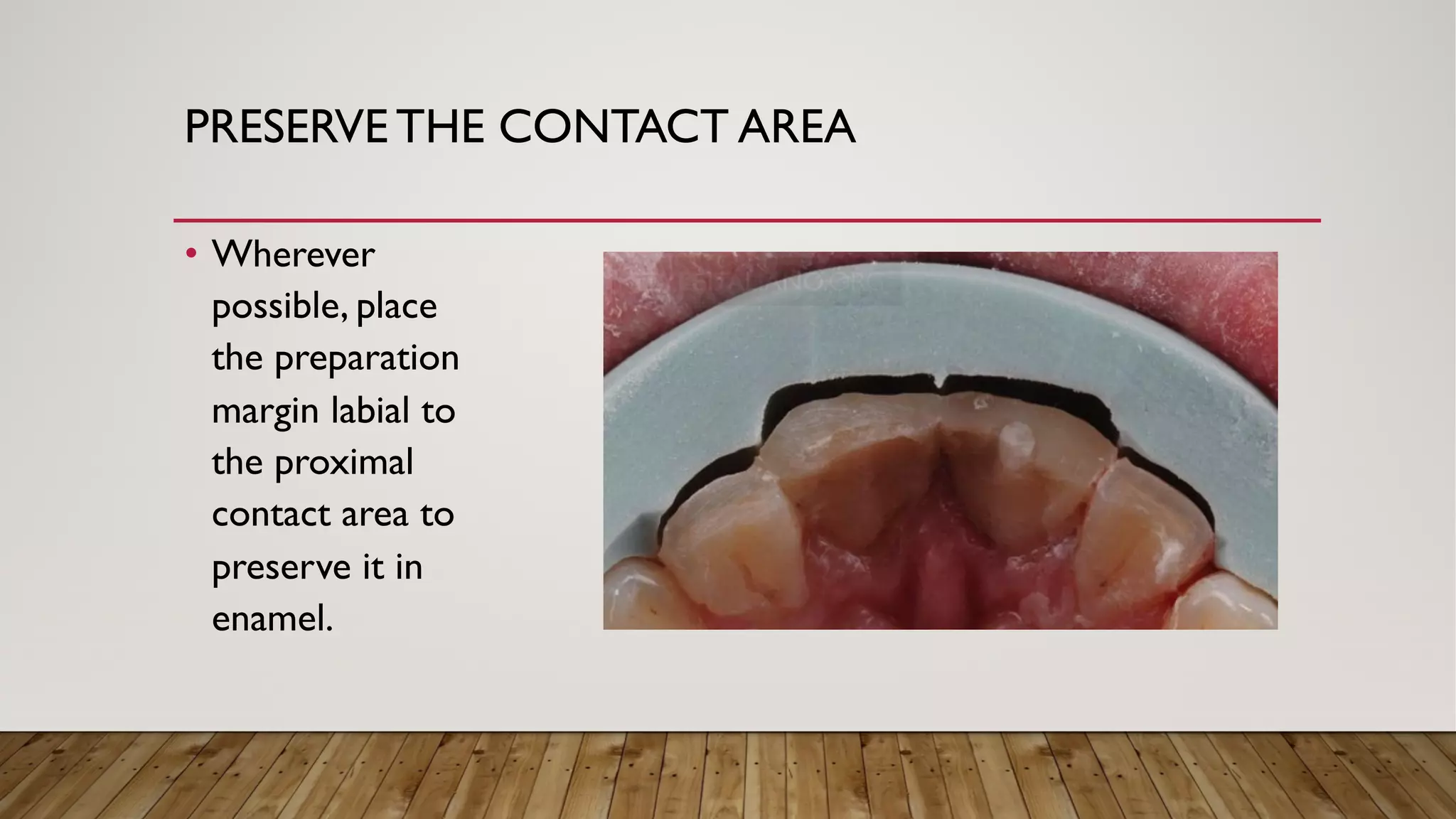 PORCELAIN LAMINATE VENEERS.pdf