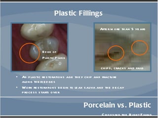 Porcelain Vs Plastic Consult | PPT | Dental Health | Diseases and ...