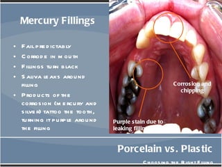 Porcelain Vs Plastic Consult | PPT | Dental Health | Diseases and ...