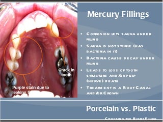 Porcelain Vs Plastic Consult | PPT