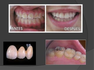 Porcelanas feldespaticas.edith correa | PPTX