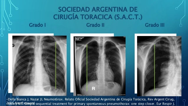 Porcentaje de neumotorax