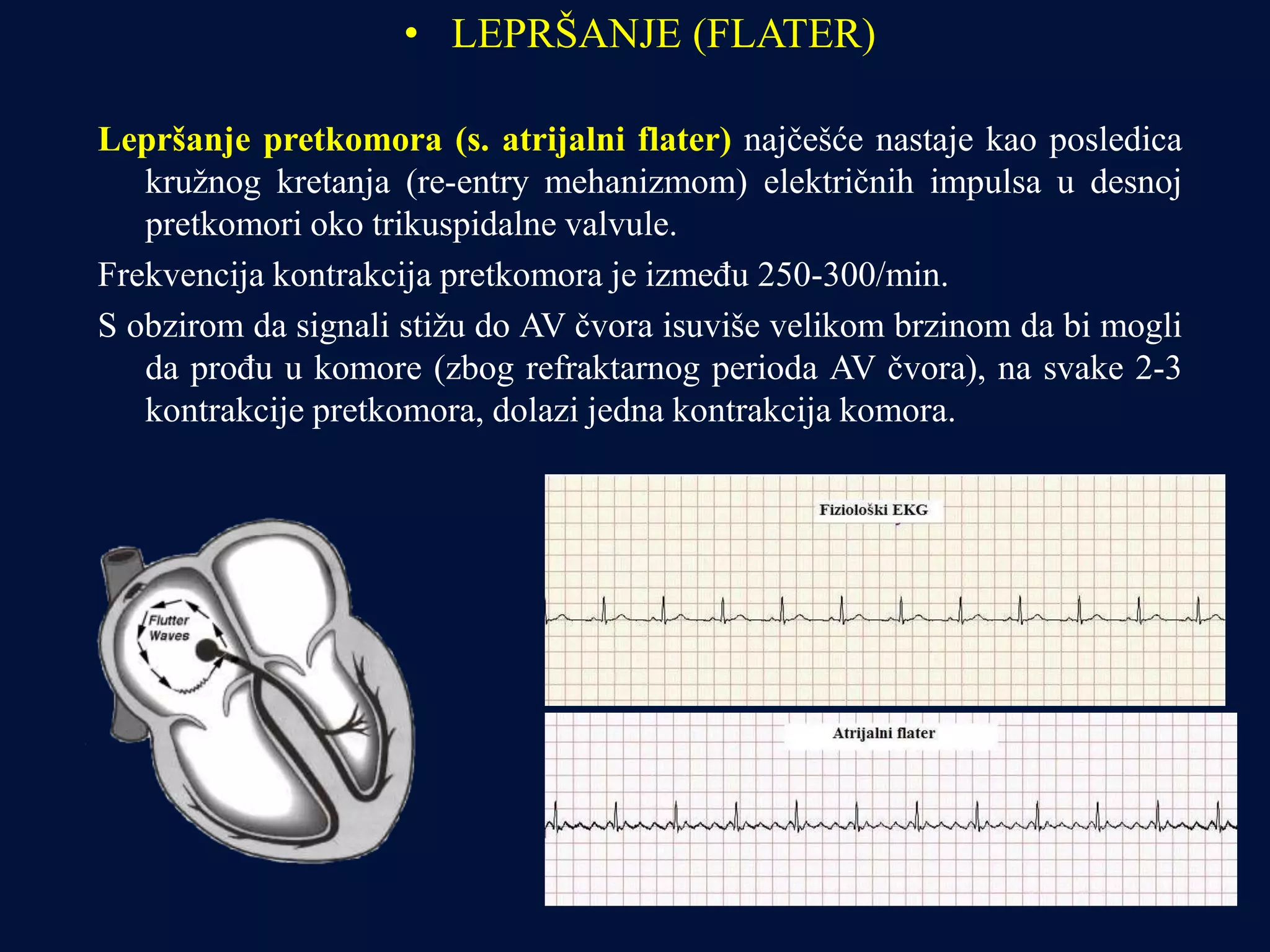 POREMEĆAJI SRČANOG RITMA.ppt