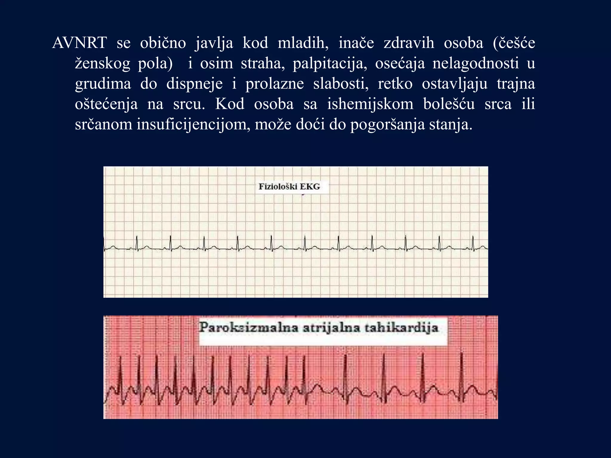 POREMEĆAJI SRČANOG RITMA.ppt