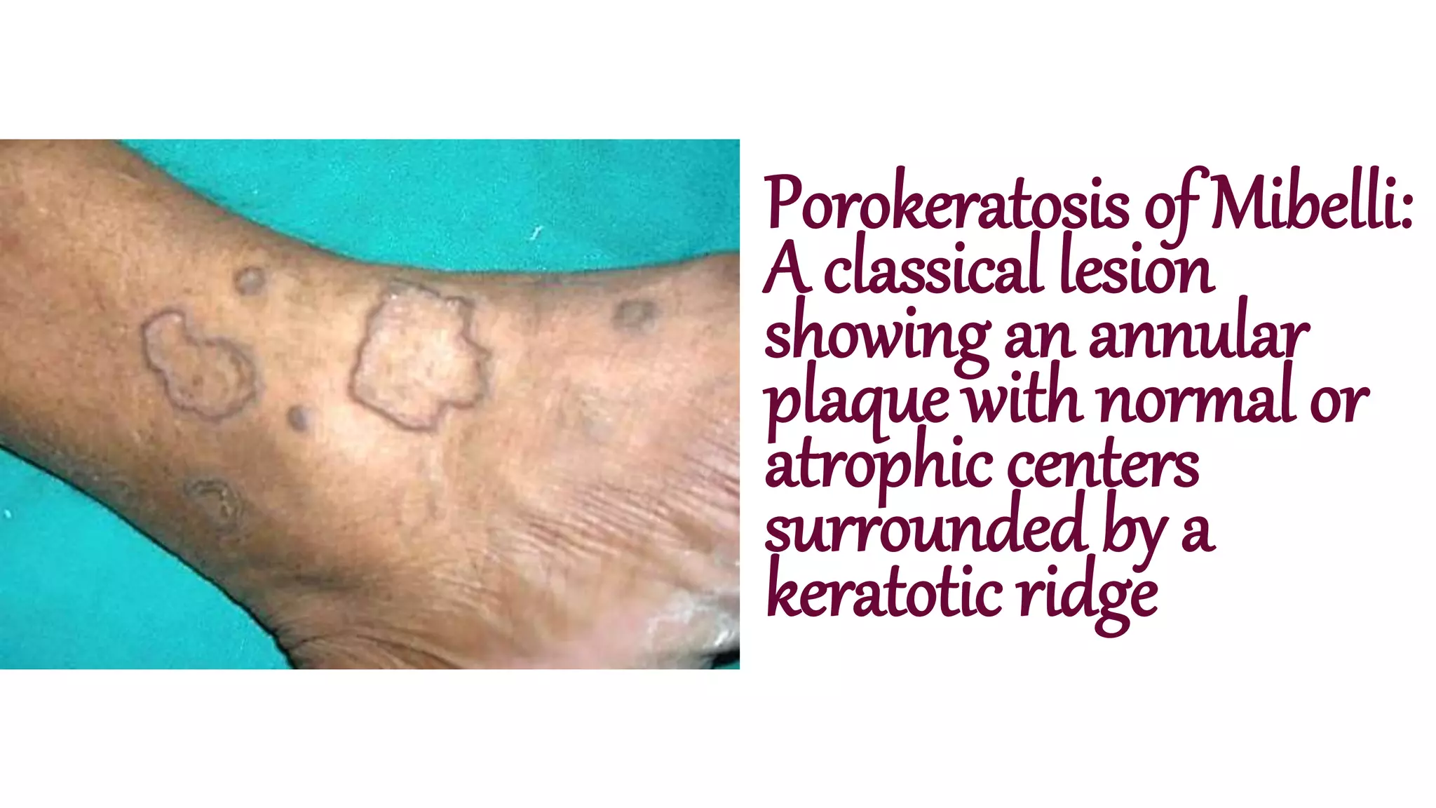 Porokeratosis | PPTX