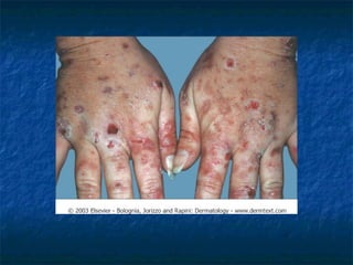 Porphyria | PPT