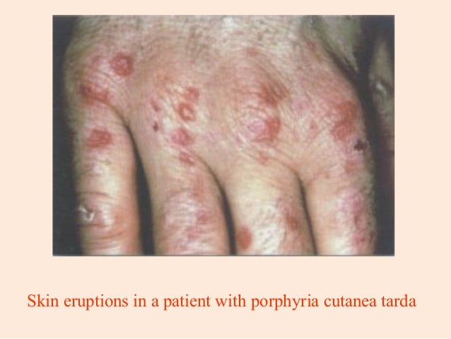 Porphyria