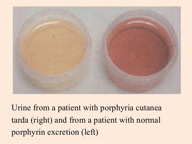 Porphyria
