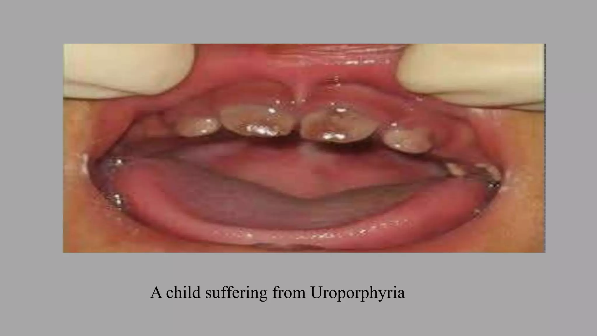 Porphyria | PPTX