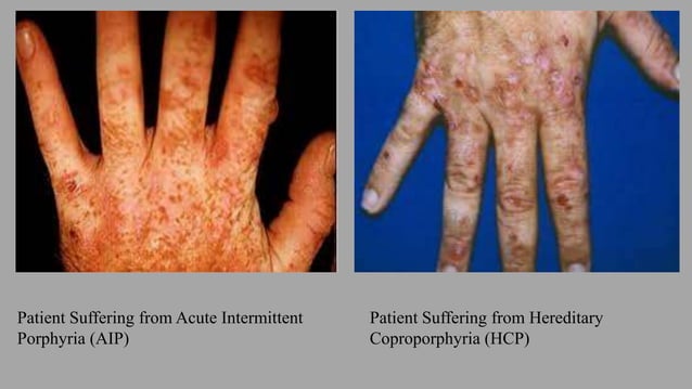 Porphyria | PPTX | Blood Disorders | Diseases and Conditions