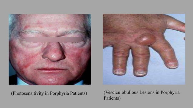 Porphyria | PPTX | Blood Disorders | Diseases and Conditions