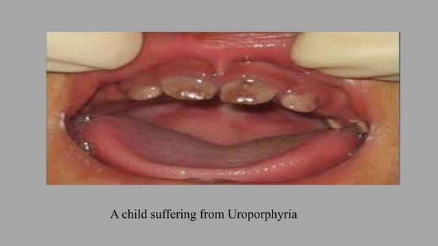 Porphyria | PPTX | Blood Disorders | Diseases and Conditions