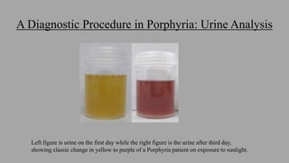 Porphyria | PPTX | Blood Disorders | Diseases and Conditions