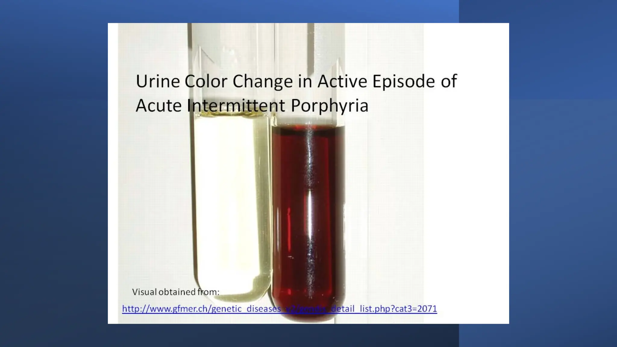 porphyria - Different types, clinical diagnosis | PPTX