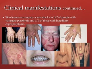 Porphyria | PPT