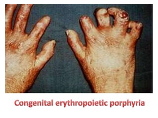 Congenital Erythropoietic Porphyria Vampire
