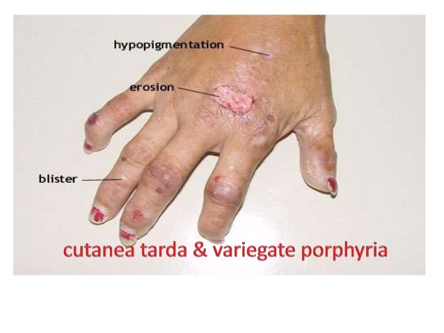 Porphyria the vampire disease