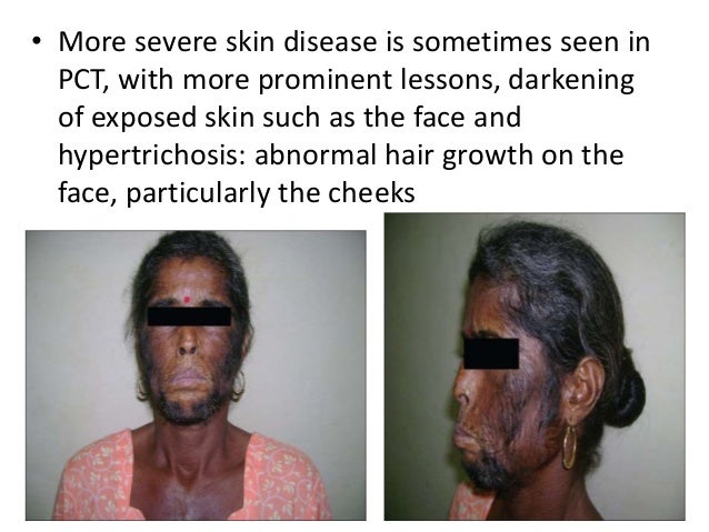 Porphyria the vampire disease