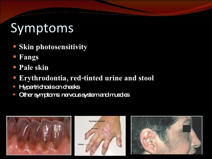 Porphyria And The Myth Of The Vampire