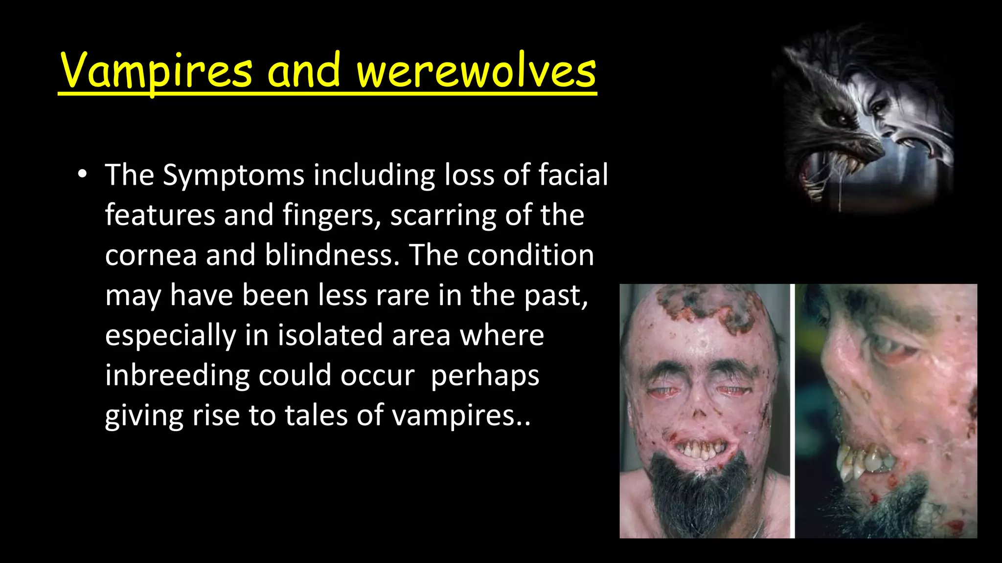 Porphyria - the vampire disease | PPTX