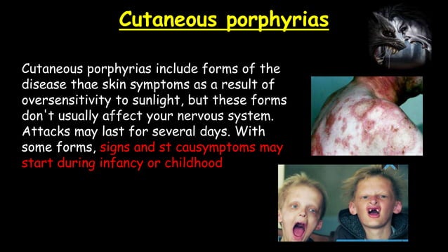 Porphyria - the vampire disease | PPT