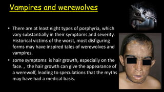 Porphyria - the vampire disease | PPT