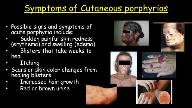 Porphyria - the vampire disease
